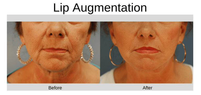 Aesthetics of the Lips - Grotting Plastic Surgery and Medspa