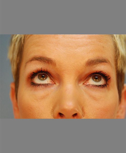 Before and After Case #1450 Photos | Birmingham, AL | Grotting Plastic ...