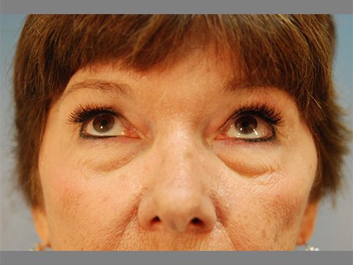 Before and After Case #7848 Photos | Birmingham, AL | Grotting Plastic ...