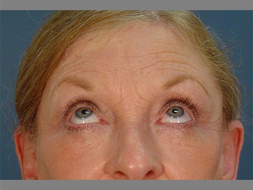 Before and After Case #1874 Photos | Birmingham, AL | Grotting Plastic ...