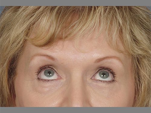 Before and After Case #622 Photos | Birmingham, AL | Grotting Plastic ...