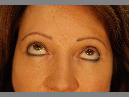 Before and After Case #4445 Photos | Birmingham, AL | Grotting Plastic ...