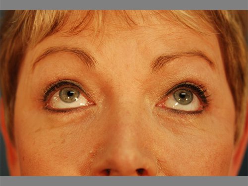 Before and After Case #3010 Photos | Birmingham, AL | Grotting Plastic ...