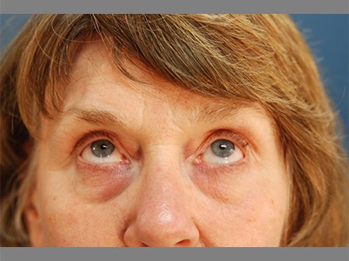Before and After Case #6508 Photos | Birmingham, AL | Grotting Plastic ...