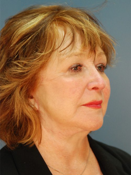 Before and After Case #4984 Photos | Birmingham, AL | Grotting Plastic ...