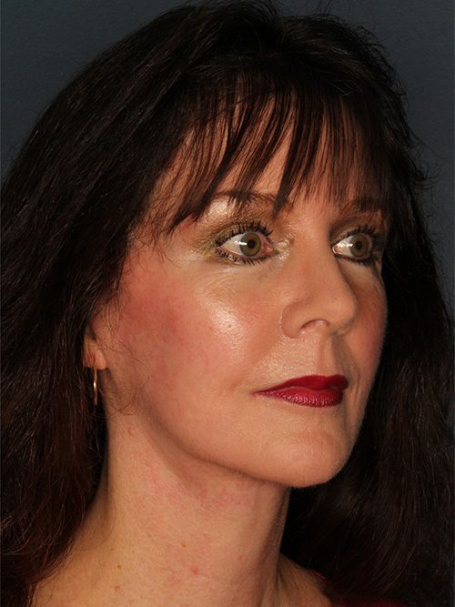 Before and After Case #3234 Photos | Birmingham, AL | Grotting Plastic ...