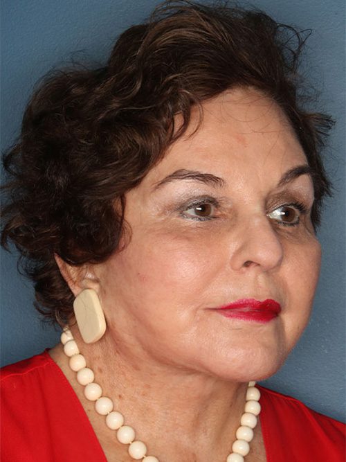 Before and After Case #6415 Photos | Birmingham, AL | Grotting Plastic ...