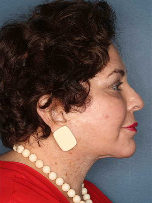 Before and After Case #6415 Photos | Birmingham, AL | Grotting Plastic ...