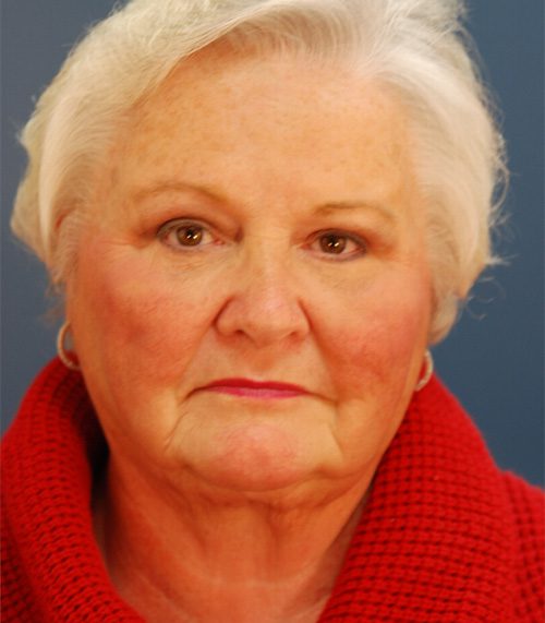 Before and After Neck Contouring Using Liposuction | Birmingham, AL ...