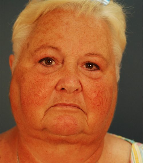 Before and After Neck Contouring Using Liposuction | Birmingham, AL ...