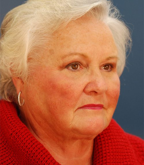 Before and After Case #3945 Photos | Birmingham, AL | Grotting Plastic ...