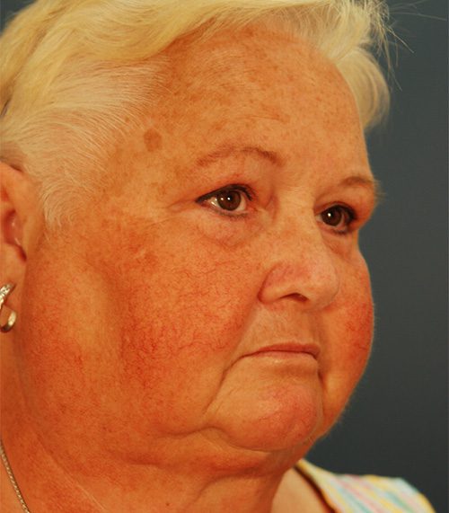 Before and After Case #3945 Photos | Birmingham, AL | Grotting Plastic ...