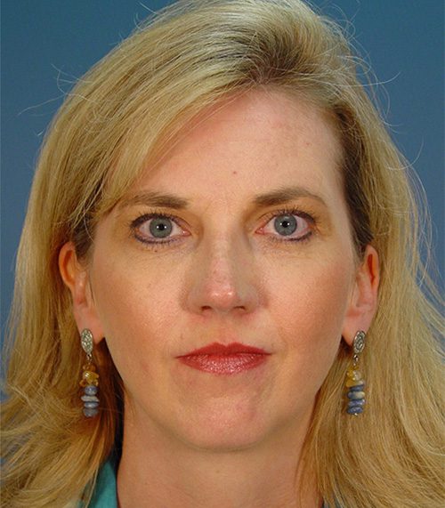 Before and After Neck Contouring Using Liposuction | Birmingham, AL ...