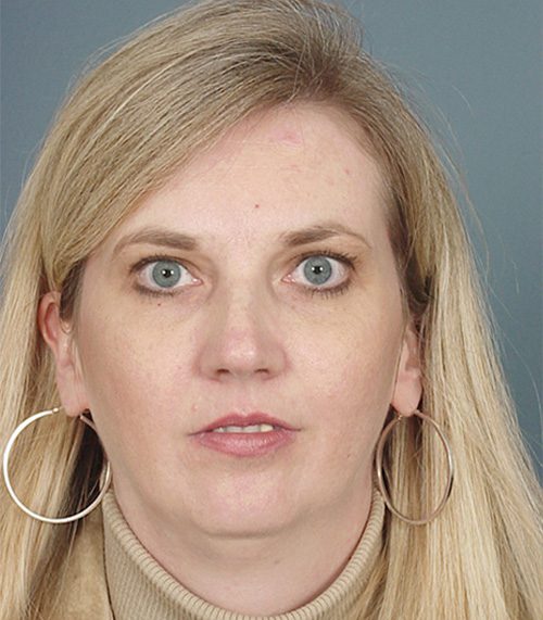 Before and After Neck Contouring Using Liposuction | Birmingham, AL ...