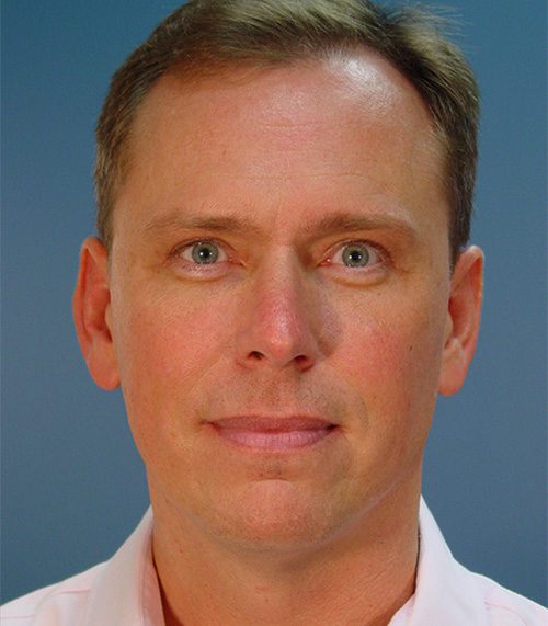 Before and After Neck Contouring Using Liposuction | Birmingham, AL ...