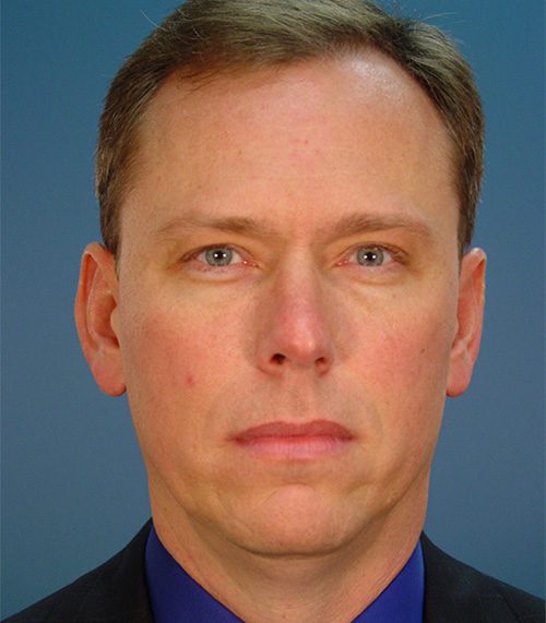 Before and After Neck Contouring Using Liposuction | Birmingham, AL ...