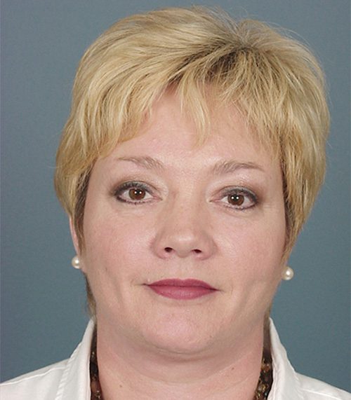 Before and After Neck Contouring Using Liposuction | Birmingham, AL ...