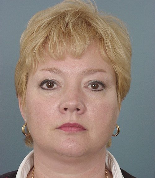 Before and After Neck Contouring Using Liposuction | Birmingham, AL ...