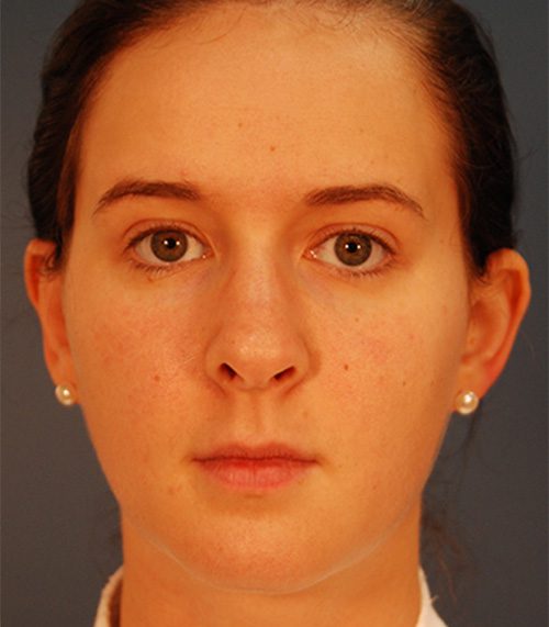 Before and After Neck Contouring Using Liposuction | Birmingham, AL ...