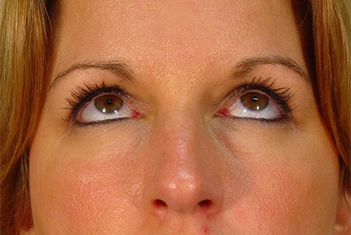 Before and After Case #1186 Photos | Birmingham, AL | Grotting Plastic ...