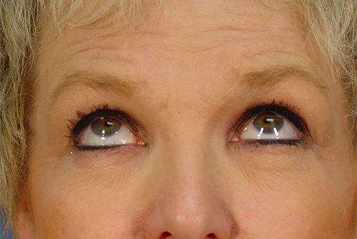 Before and After Case #2949 Photos | Birmingham, AL | Grotting Plastic ...