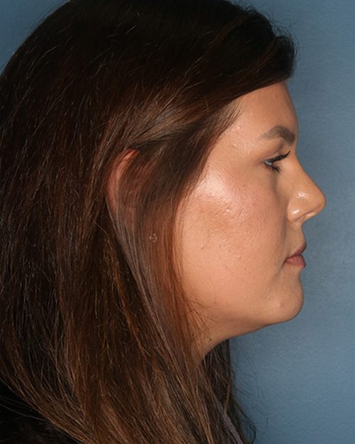 Before and After Case #5666 Photos | Birmingham, AL | Grotting Plastic ...