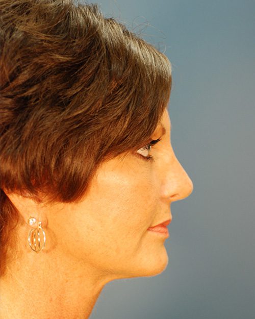 Before and After Case #5902 Photos | Birmingham, AL | Grotting Plastic ...