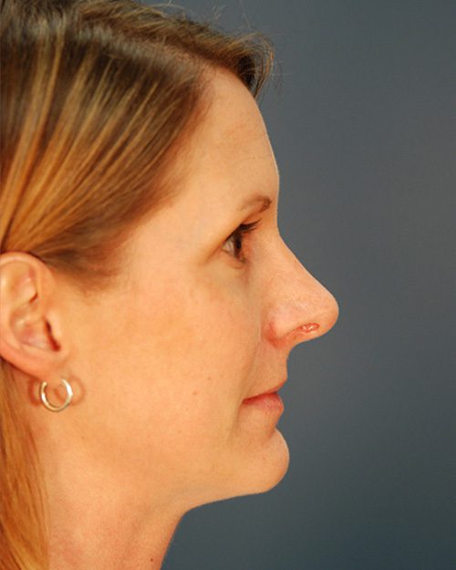 Before and After Case #9653 Photos | Birmingham, AL | Grotting Plastic ...