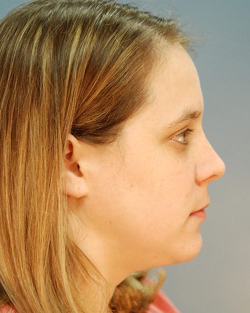 Before and After Case #2994 Photos | Birmingham, AL | Grotting Plastic ...