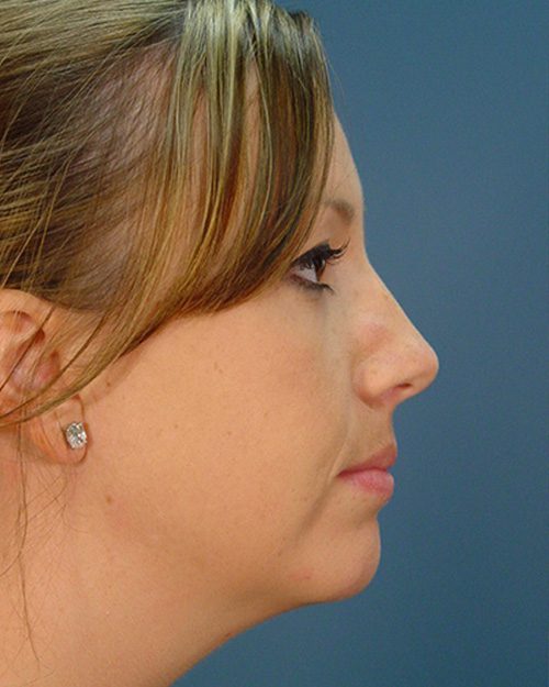 Before and After Case #7160 Photos | Birmingham, AL | Grotting Plastic ...