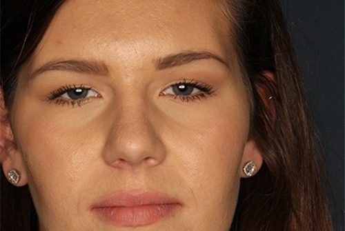 Before and After Case #3008 Photos | Birmingham, AL | Grotting Plastic ...