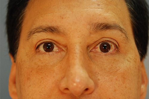 Before and After Upper Eyelid Surgery | Birmingham, AL | Grotting ...